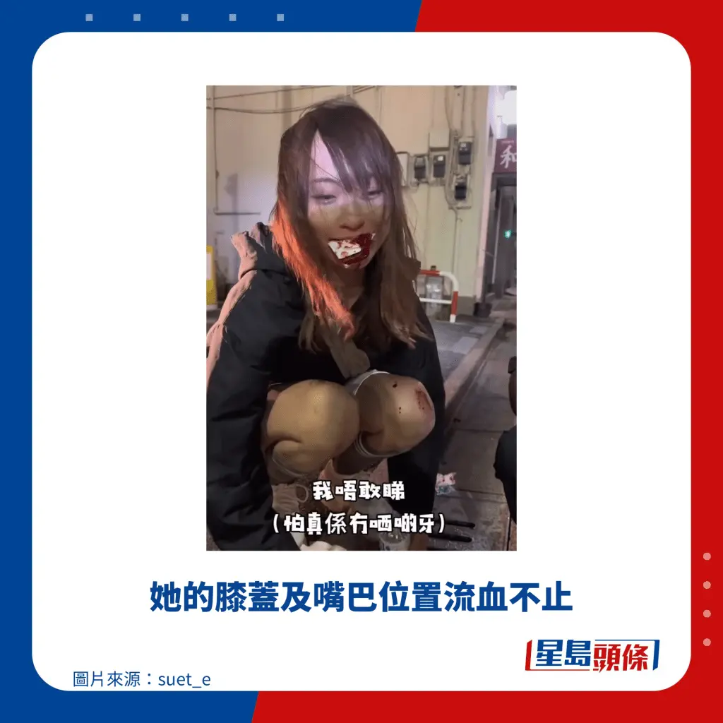 性感KOL Suet E遊日玩電動滑板 慘炒車當場爆牙+紙巾染血 | LIHKG 討論區